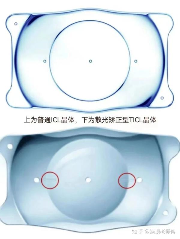 散光ICL晶体真的容易旋转和移位吗？ICL和TICL有什么区别？ - 知乎