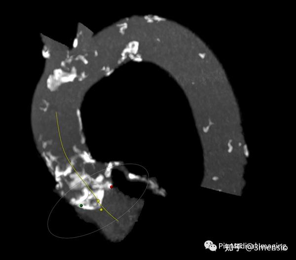 3mensio Aortic 