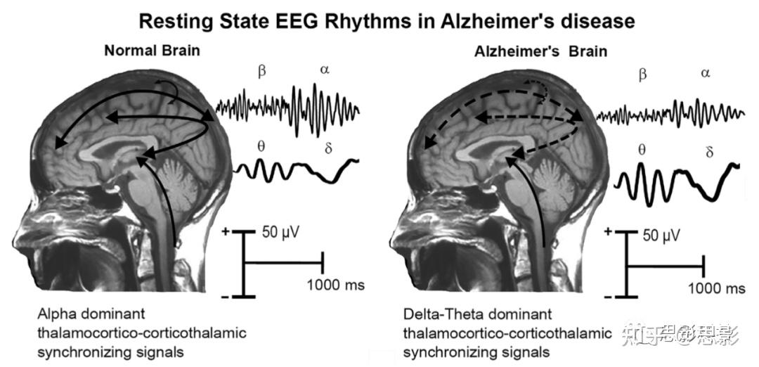 阿尔茨海默病临床试验中静息脑电节律的测量 - 知乎