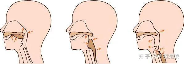 实用|关于吞咽障碍的康复训练 - 知乎