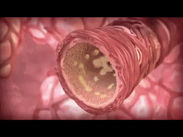 你不知道的“sd-LDL-C”和"LPO"——更明确地预测严重心血管疾病、甚至死亡！ - 知乎