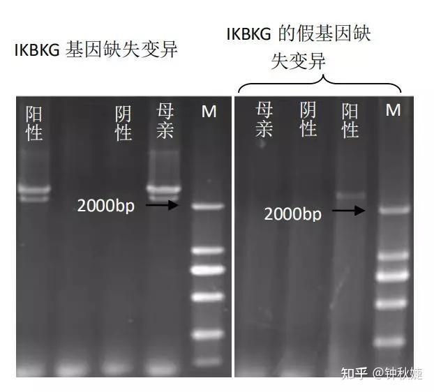 色素失禁症（IP）的基因检测 - 知乎