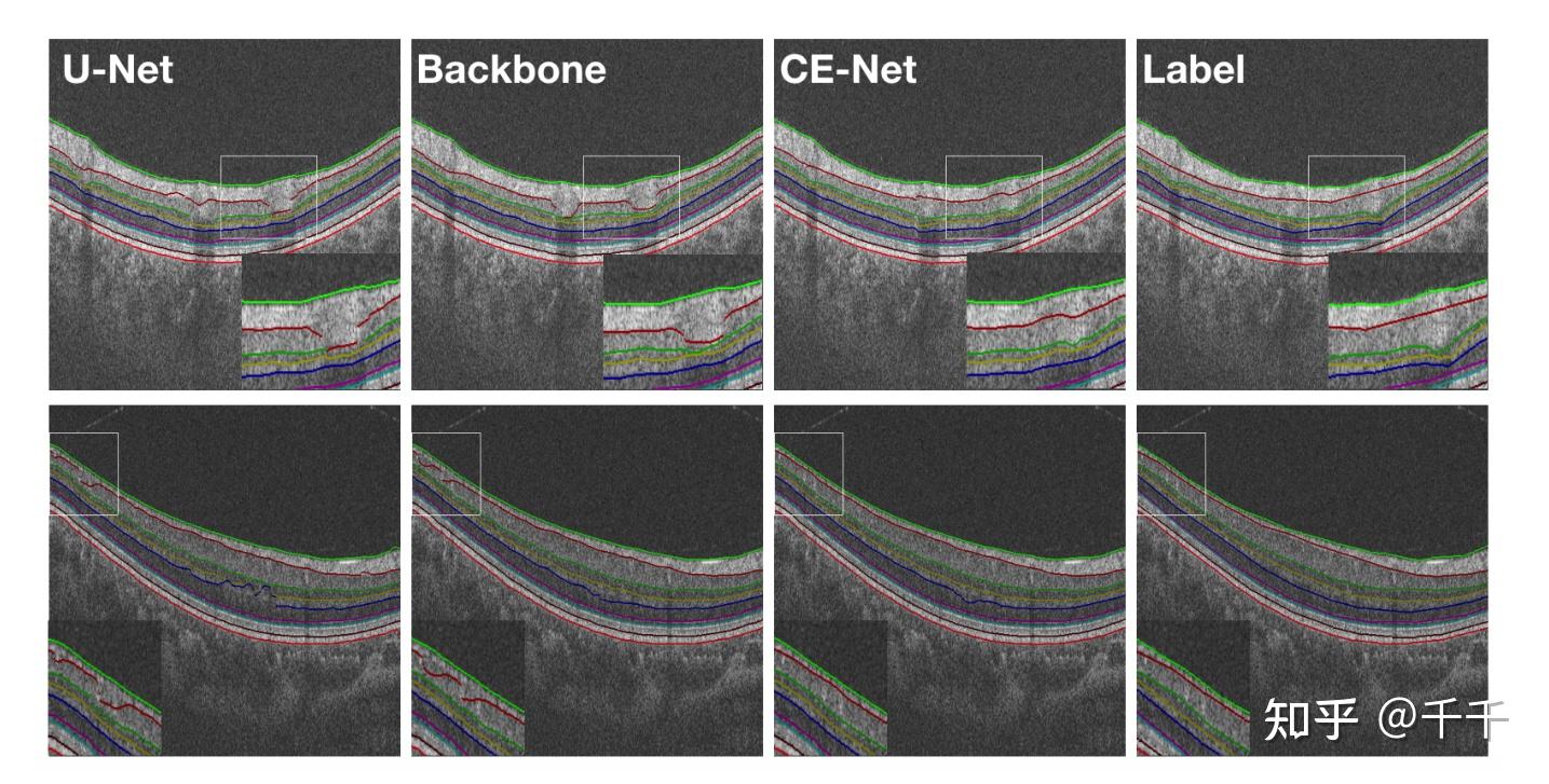 CE-Net: Context Encoder Network for 2D Medical Image Segmentation（译文） CE-Net：用于2D医学图像分割的上下文编码器网络 ...