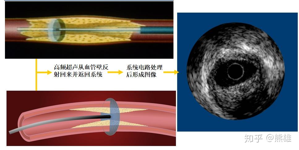 血管内超声（IVUS）概述（一） - 知乎