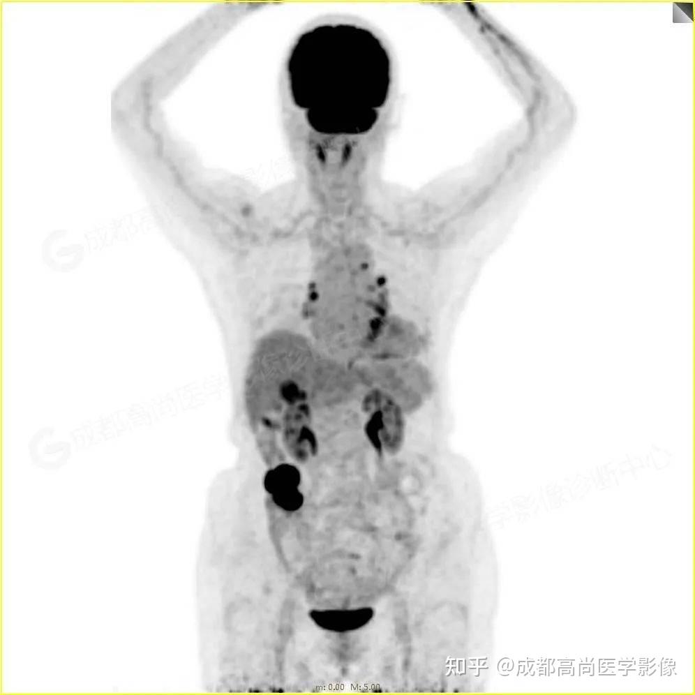 【高尚病例】PET/CT诊断结肠癌1例 - 知乎