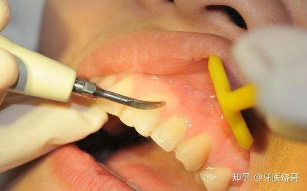 牙龈萎缩，牙根都快露出来了，刷牙时酸痛，该如何挽救？ 知乎