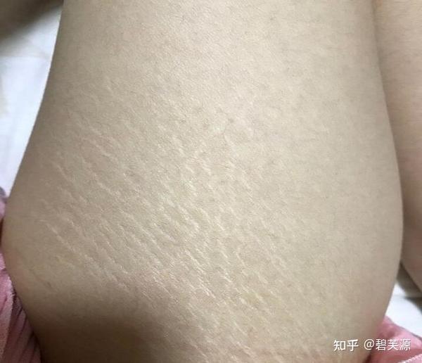 身上有肥胖纹怎么祛除? 知乎
