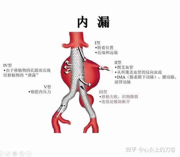 主动脉支架内漏分型及治疗策略 - 知乎