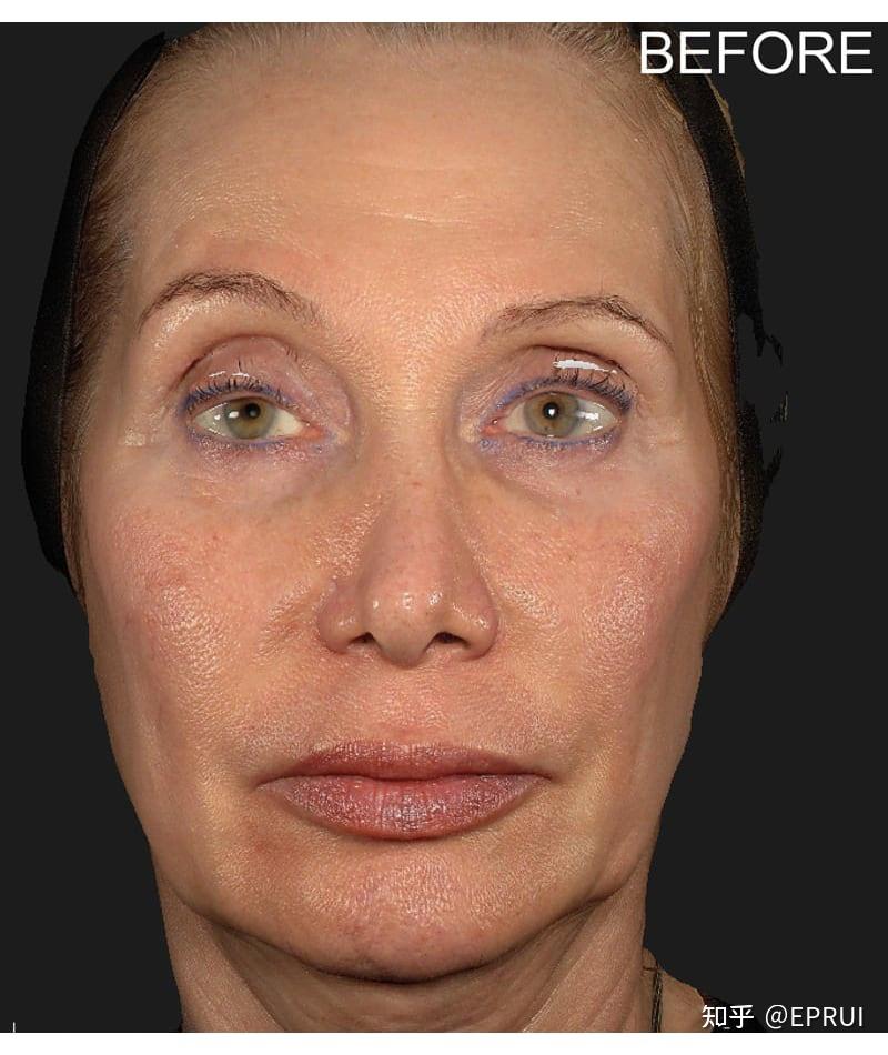 25-45um 医美用CaHA羟基磷灰石微球 - 知乎