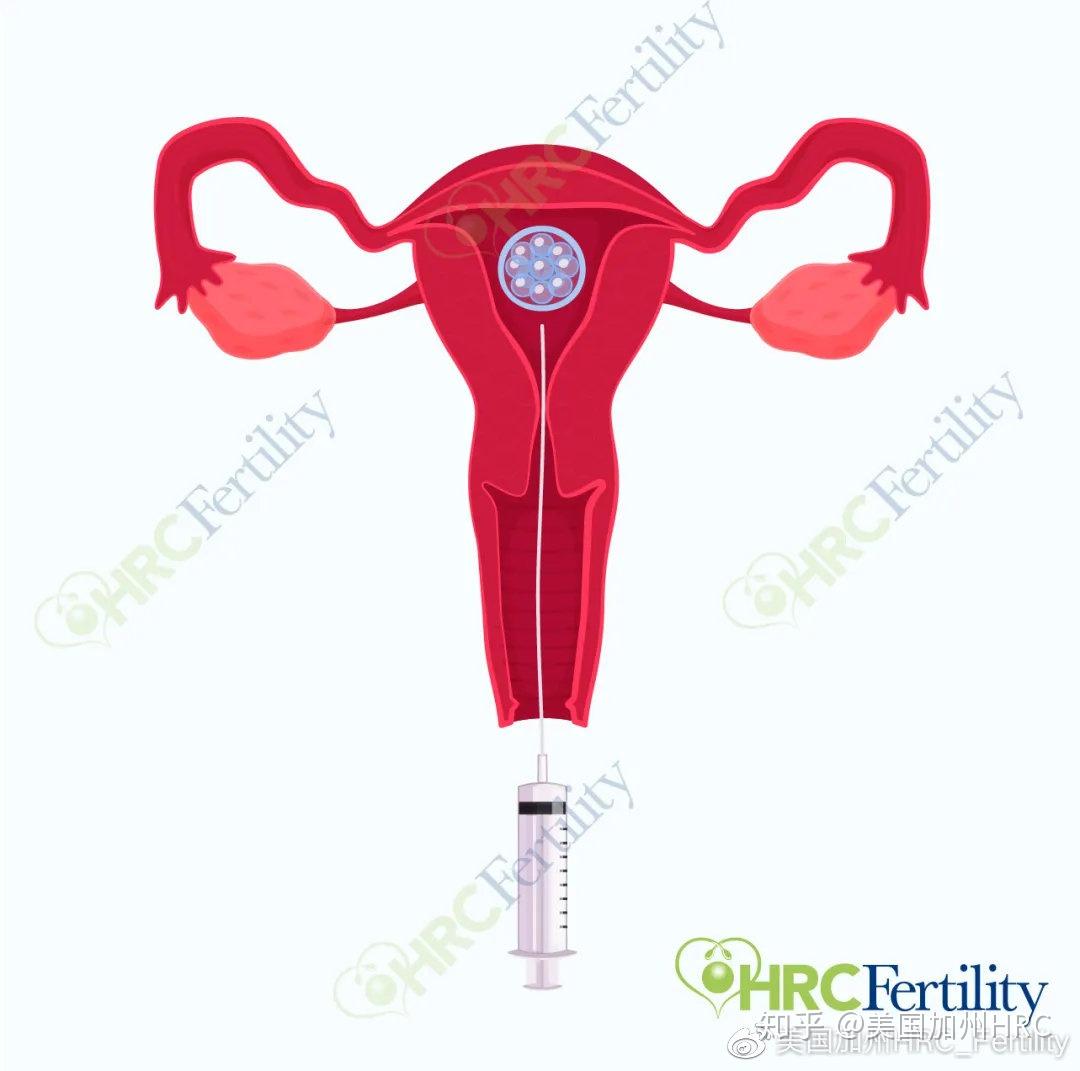 HRC课堂｜Dr. Tourgeman: 胚胎移植前，需要子宫做好哪些准备？ - 知乎