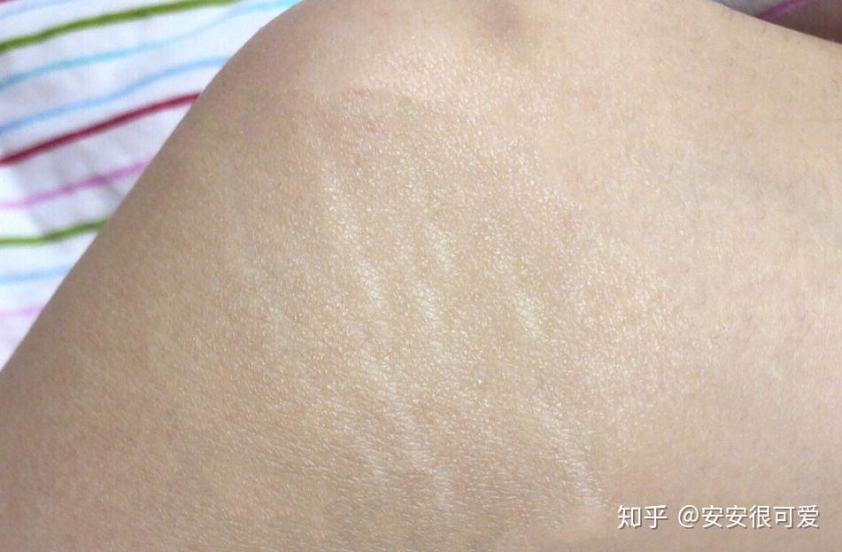女生有肥胖纹怎么拯救? 知乎