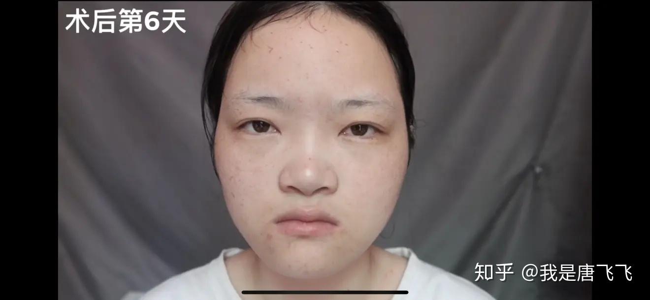 我去做超皮秒了，手术过程和30天恢复记录分享【整容】【医美】 知乎
