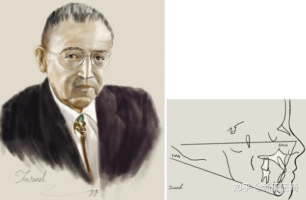 学术正畸｜超详细口腔正畸学发展史（下篇） - 知乎