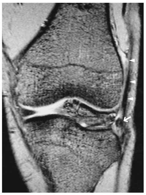 Segond骨折与Gerdy结节撕脱性骨折磁共振要点 - 知乎