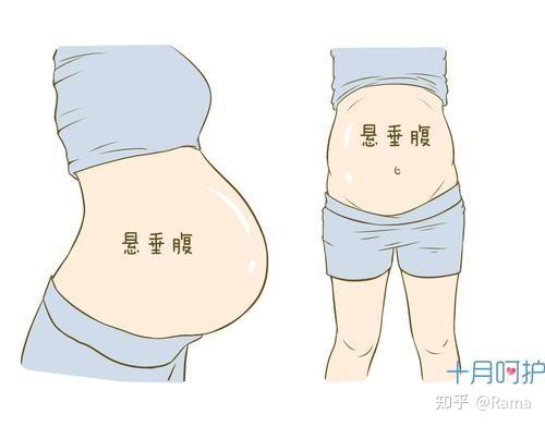 孕期 悬垂腹 知乎