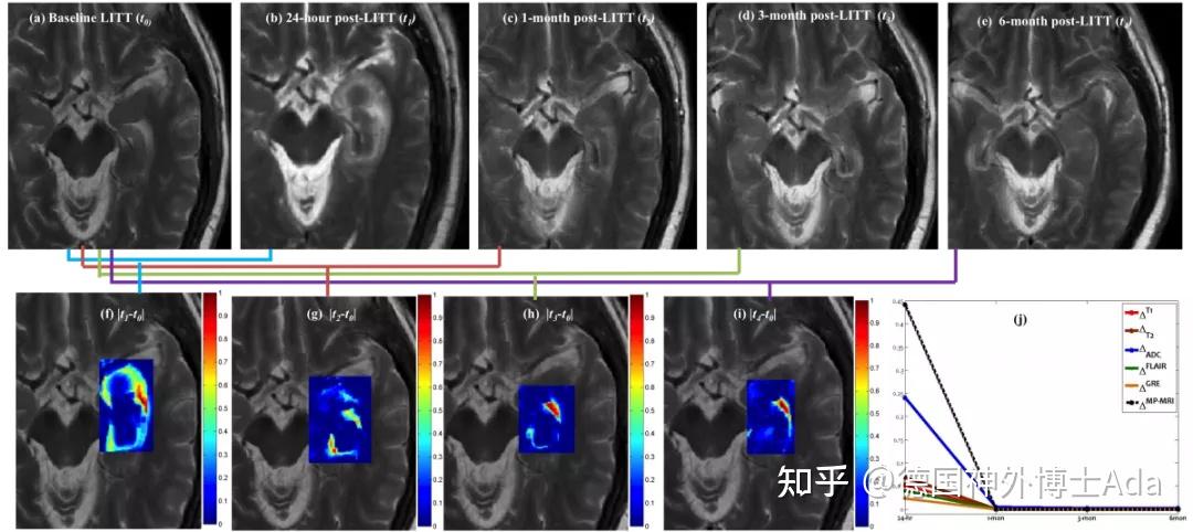 全国首例磁共振实时监测颅内激光消融(LITT)手术在北京天坛医院完成，LITT究竟是何黑科技？ - 知乎
