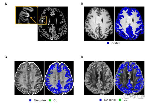 基于NODDI方法检测多发性硬化症的皮质损害 - 知乎