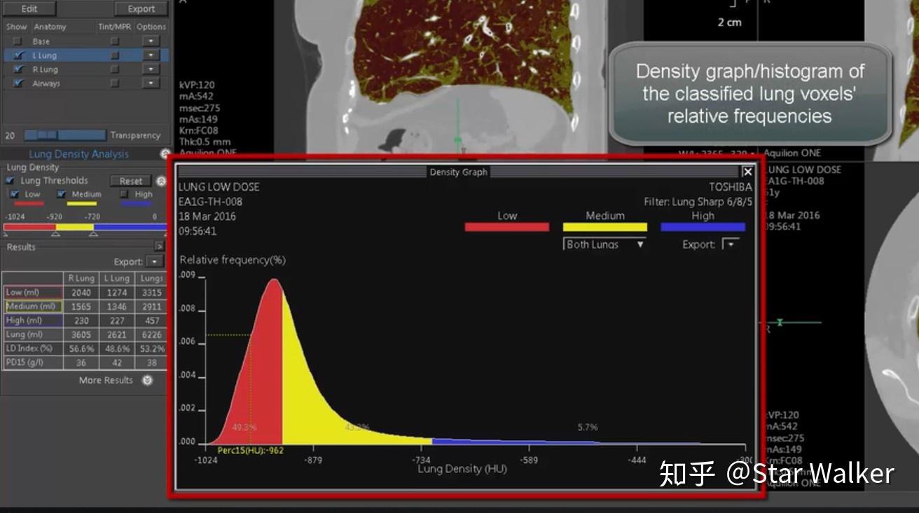 关于影像后处理工作站的点滴分享——肺部CT密度分析 - 知乎