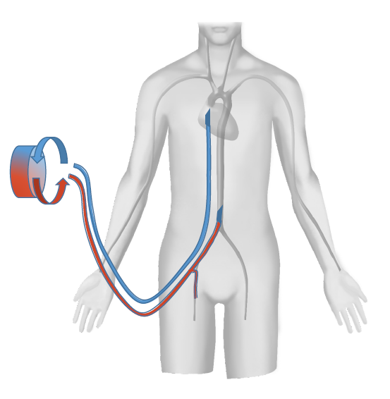ECMO基础知识，最全总结！ - 知乎