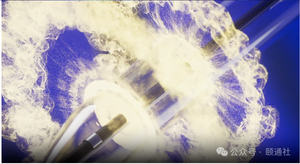 激光IVL系统首例人体应用：360°能量输出，破解血管钙化禁区难题 - 知乎