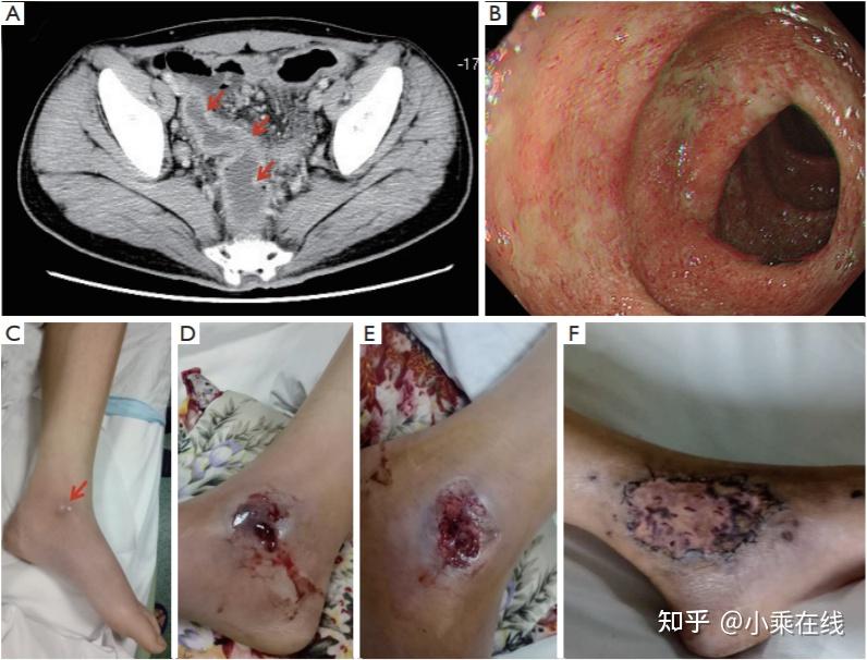 Pyoderma gangrenosum in ulcerative colitis - 知乎