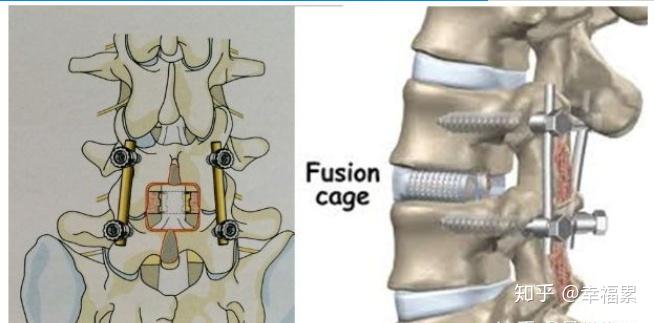UBE 这些差别你知道吗？PLF PLIF TLIF DLIF XLIF 手术技术对比【医术苑】科普 - 知乎