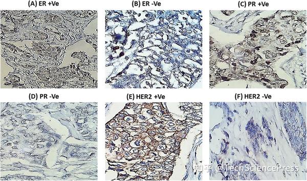 【OR编辑推荐】乳腺癌研究进展！解读最新论文，带你走进乳腺癌治疗的前沿！ - 知乎