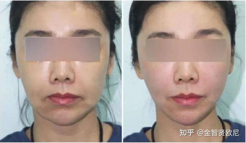 为什么面部下垂更适合用超声炮?超声炮正确用法一篇get! 知乎