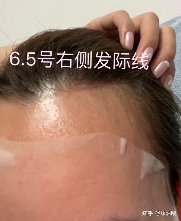 拯救发际线第72天！明显改善发际线凹陷，发缝稀疏等问题！！ 知乎