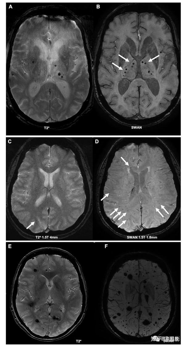 磁敏感加权成像（SWI)：技术要点和临床神经学应用 - 知乎