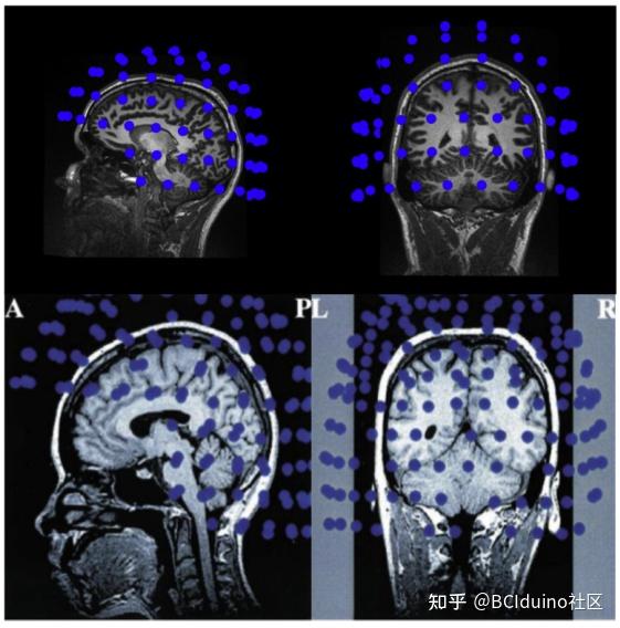 学术篇 | 脑电图和脑磁图能探测到来自人类小脑的信号吗？ - 知乎