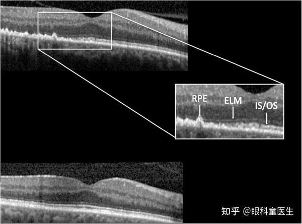 后葡萄膜炎——3、梅毒性视网膜脉络膜炎 - 知乎