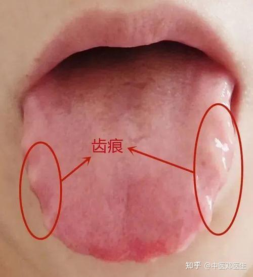 舌有齿痕，我来说说一个方子，对症的朋友可以了解 知乎