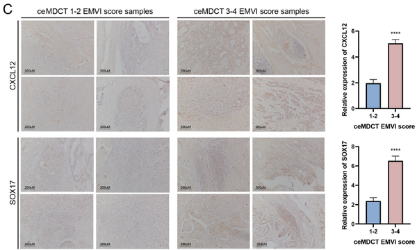 从临床问题切入，分析壁外血管侵犯(EMVI)和免疫相关基因！这篇8分+生信文章极具借鉴意义，还告诉你验证实验这么加更有价值~ - 知乎