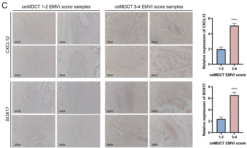 从临床问题切入，分析壁外血管侵犯(EMVI)和免疫相关基因！这篇8分+生信文章极具借鉴意义，还告诉你验证实验这么加更有价值~ - 知乎