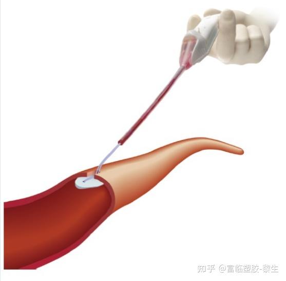 血管闭合：可以分为有源设备和无源设备 - 知乎
