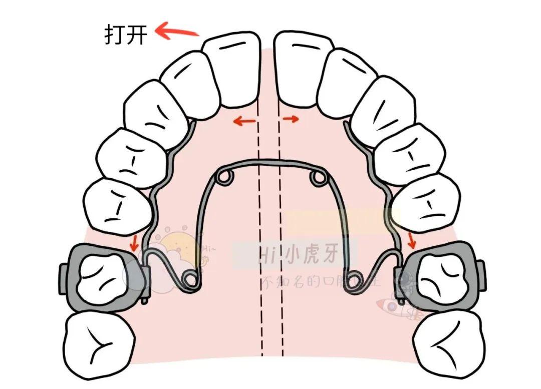 干货分享：固定式扩弓器——quad Helix扩弓器 四眼圈簧扩弓器的全面指南！值得收藏 知乎