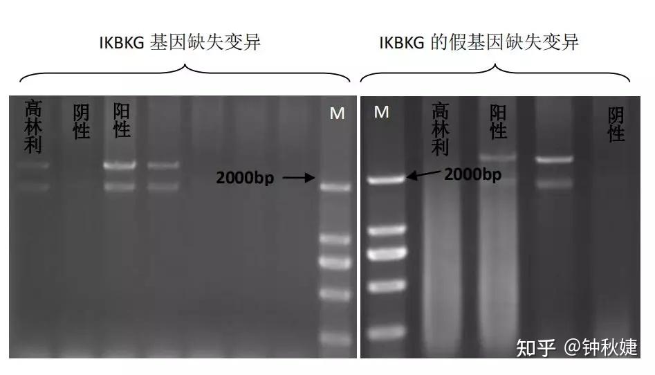 色素失禁症（IP）的基因检测 - 知乎
