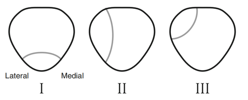 髌骨分裂磁共振表现 - 知乎