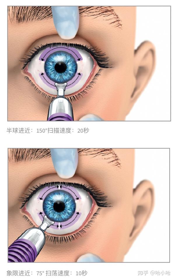带你了解MicroPulse®跨巩膜激光治疗青光眼：国际德尔福小组的指南 - 知乎