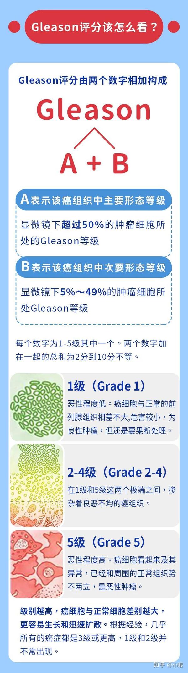 一图读懂 | 前列腺癌的Gleason评分 - 知乎