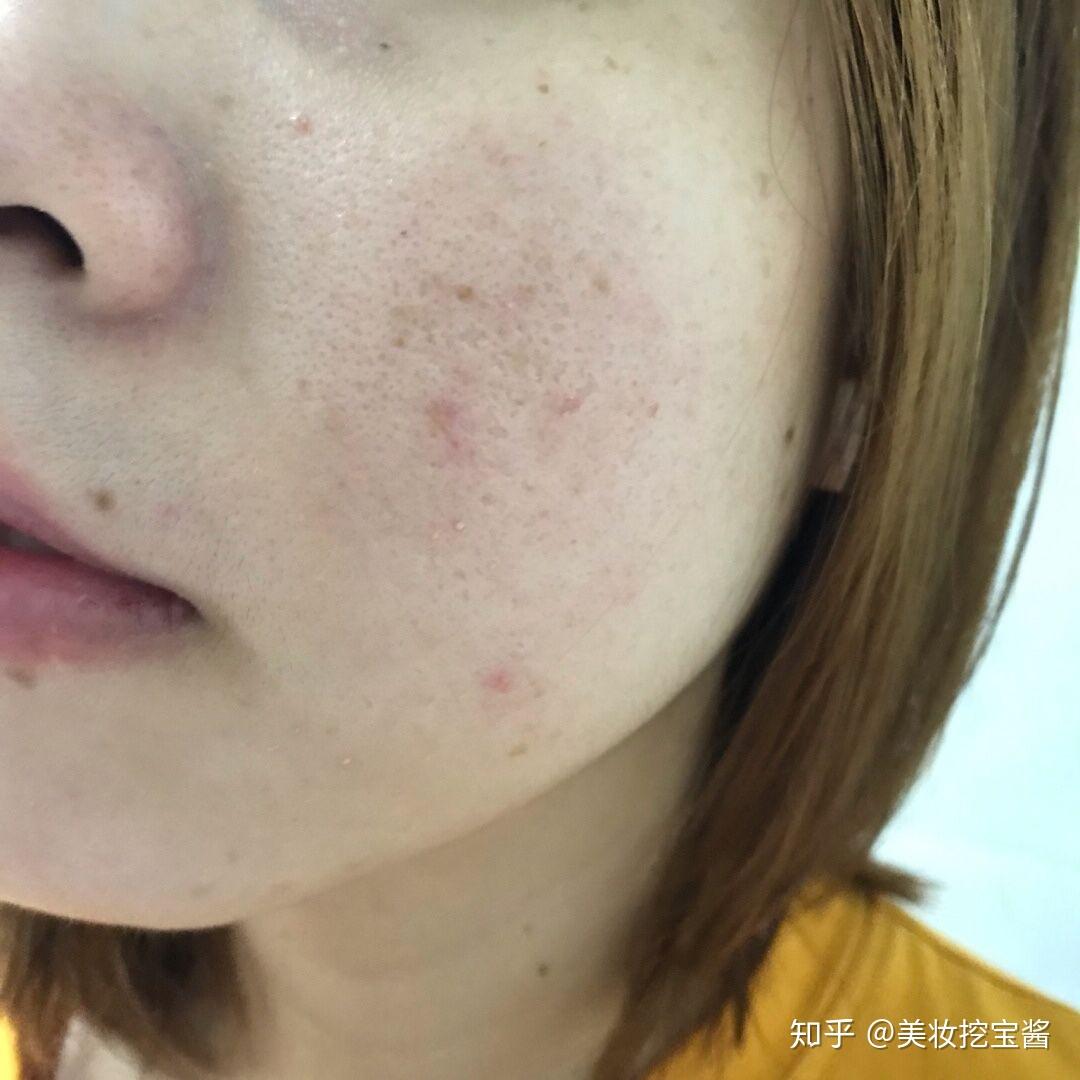 学生党如何正确祛痘 知乎