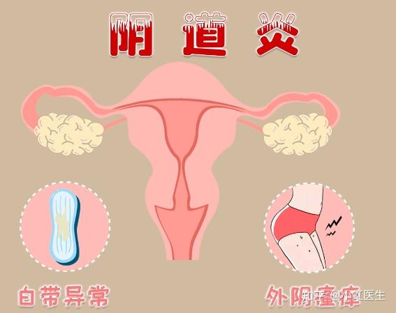 不痛不痒不用治？阴道炎的误区，看看踩中几个！ 知乎