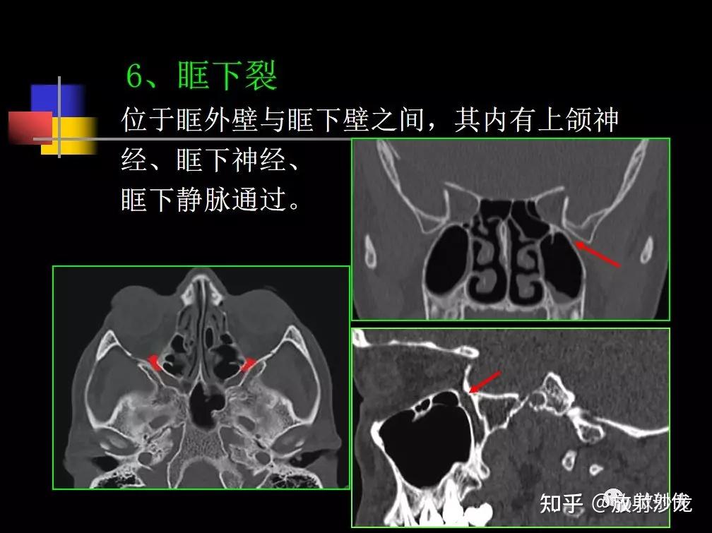 收藏必备 鼻咽部的ct详细解剖 知乎