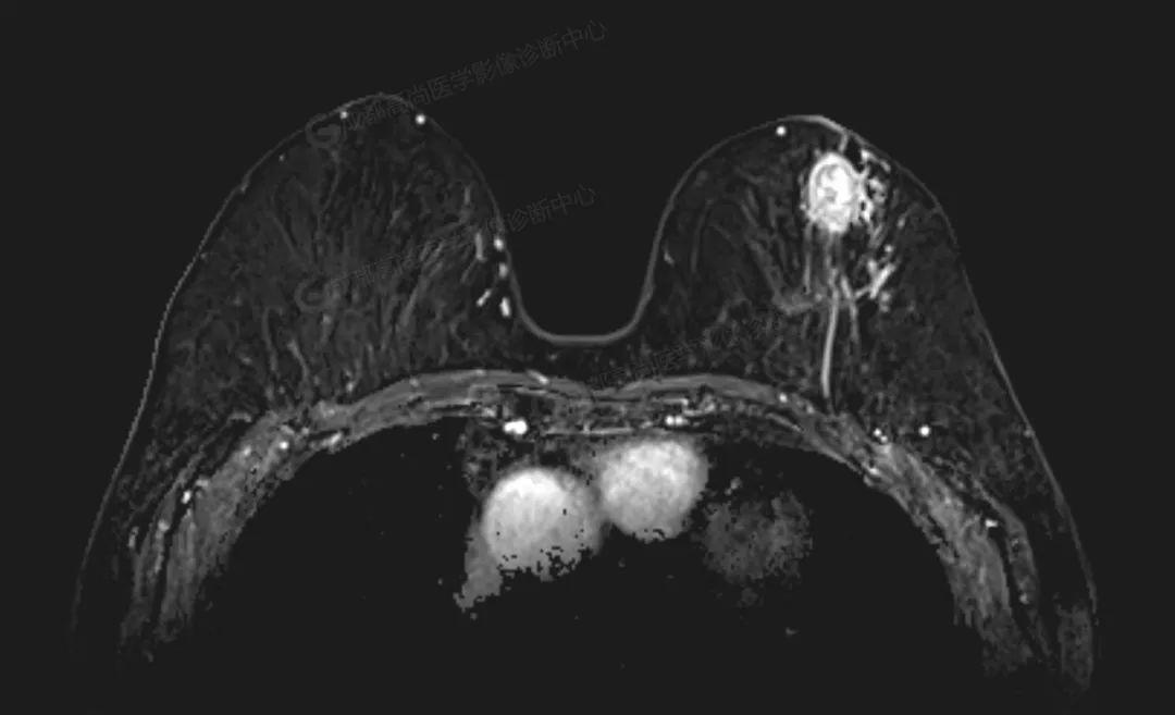 乳腺MR的临床应用 - 知乎