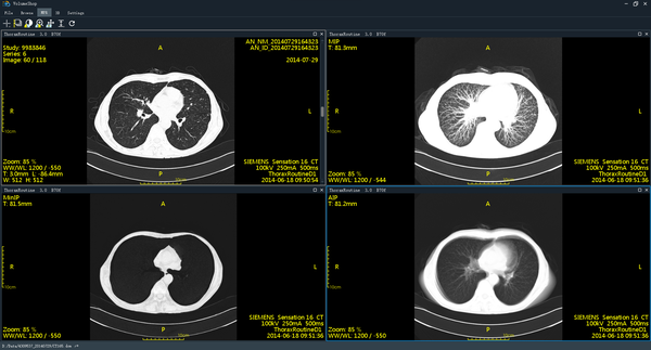 医学影像中的MIP(最大密度投影)、MinIP(最小密度投影)和AIP(平均密度投影)介绍 - 知乎
