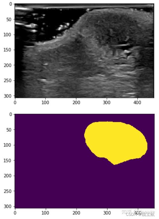 【PyTorch深度学习项目实战100例】—— 基于UNet实现血管瘤超声图像分割 | 第30例 - 知乎