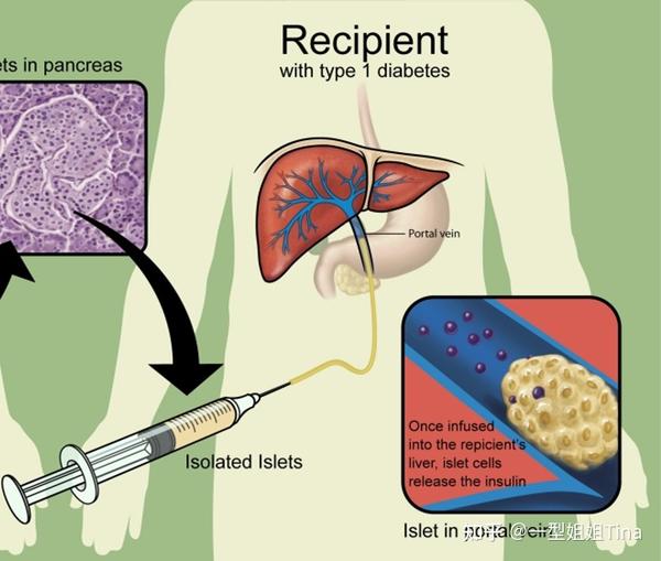 迈向糖尿病的治愈方向——干细胞治疗1（VX-880试验首例受试者阳性结果） - 知乎