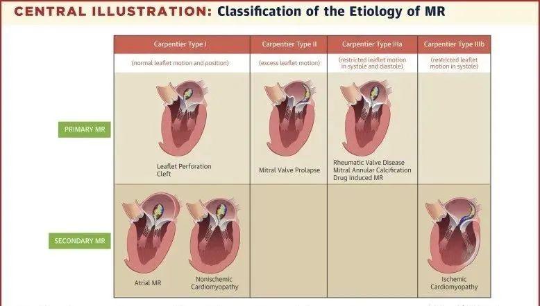 全面解析二尖瓣反流，10条要点全概括! - 知乎