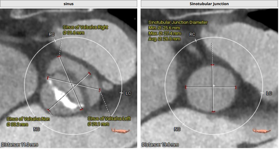 中南大学湘雅医院罗凡砚教授团队成功为两位“80后”高龄高危二叶畸形主动脉瓣重度狭窄患者行TAVR手术 - 知乎